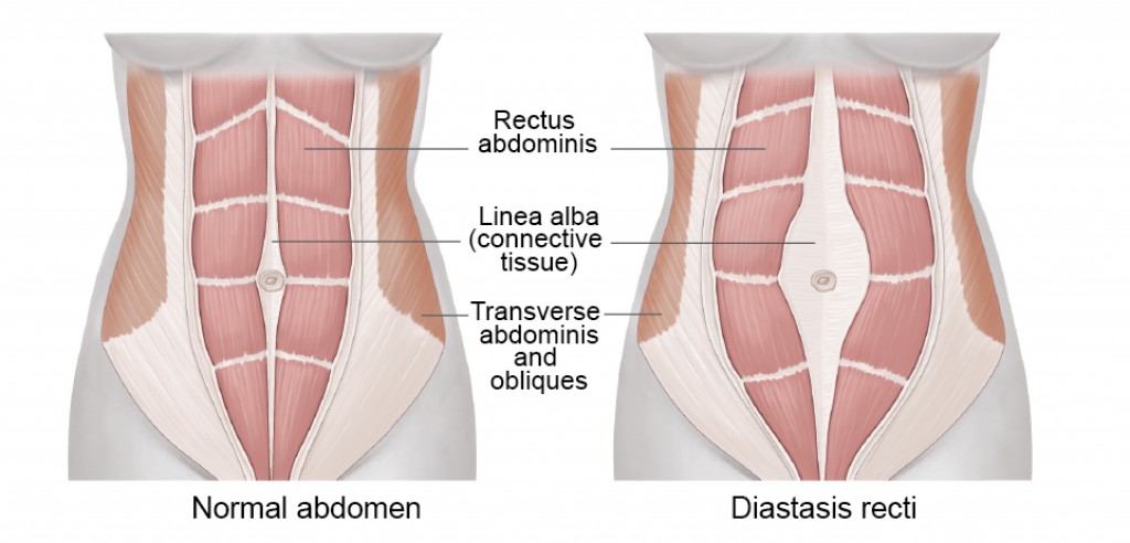 Abdominal separation explained. - RUNNING MUMS AUSTRALIA